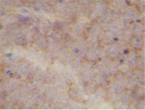Positive Synaptophysin Stain In The Tumor Download Scientific Diagram
