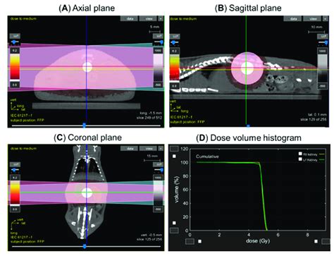Image Guided Localized Kidney Radiation Technique Computed Tomography