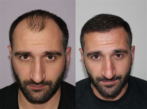 Hairline International