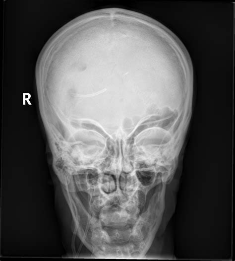Diagnostics The Shunt Series — Taming The Sru