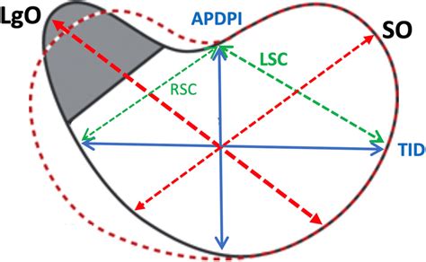 Scheme Of An Asymmetric Pelvis So Short Oblique Diameter Lgo Long