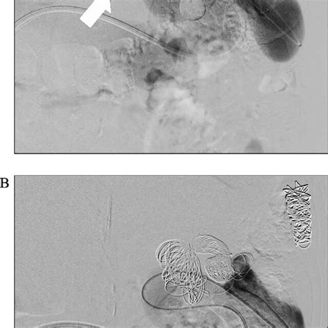 A Balloon Occluded Retrograde Transvenous Venography Brtv From The Download Scientific