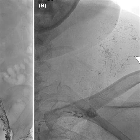 Computed Tomography Scan Obtained After Intranodal Lymphangiography