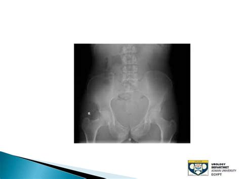 Bladder And Urethral Calculi Pptx