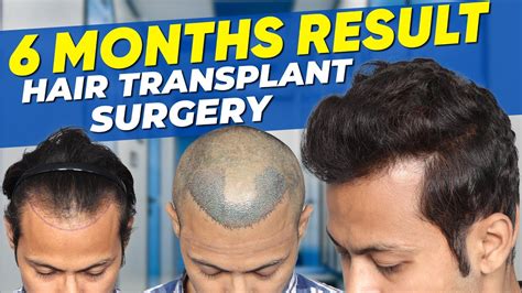 Hair Transplant In Dubai Best Results And Cost Of Hair Transplant In