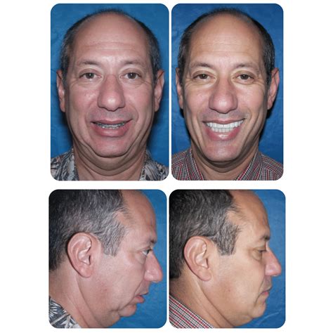 Before And After Photos Maxillofacial Surgery Larry M Wolford Dmd
