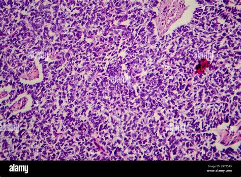 Wilms Tumor Or Nephroblastoma Light Micrograph Photo Under