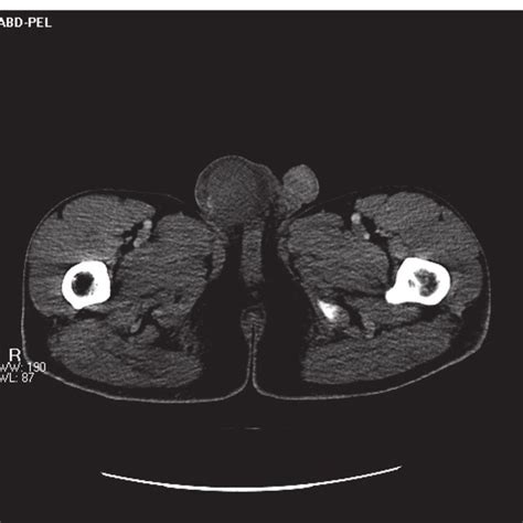 Computed Tomography Scan Ct Scan Shows A Heterogeneous 4 6 Cm Scrotal