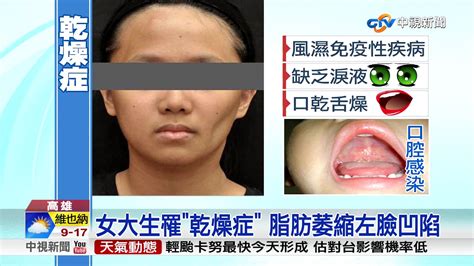 乾到半臉凹陷 18歲女大生羞於見人│中視新聞 20171009 Youtube
