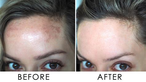 How I Got Rid Of Pigmentation Melasma Shonagh Scott YouTube