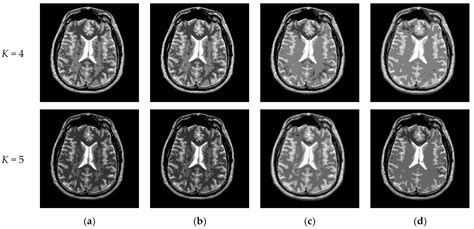 An Interval Iteration Based Multilevel Thresholding Algorithm For Brain