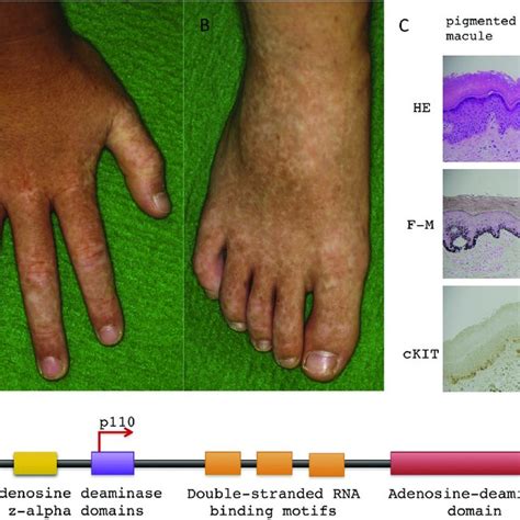 Typical Clinical And Pathological Features Of Reticulate Download