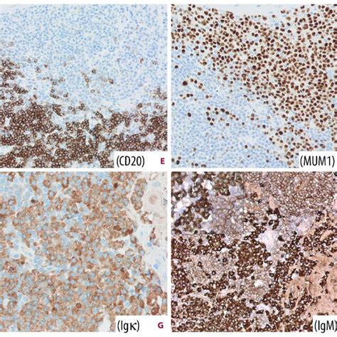 Histological And Immunohistochemical Features Of The Second Excised