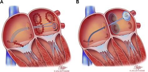 2017 Hrsehraecasaphrssolaece Expert Consensus Statement On Catheter