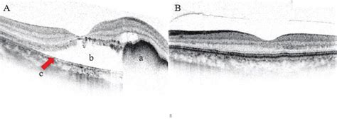 A Right Eye Oct Showing Disruption Of The Rpe Layer Download