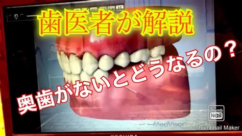 歯を抜いた後 奥歯 放置するとどうなる？下がる？説明動画64入れ歯ブリッジインプラント失敗危険？ 大宮駅西口上小町三橋大成町宮原町鈴木歯科医院