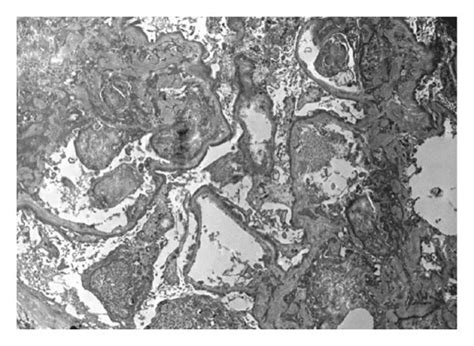 Electron Microscopy Showing More Than 90 Foot Process Effacement Download Scientific Diagram