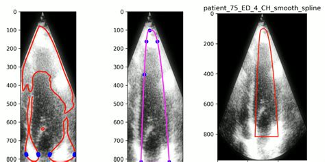 CS Cardiac D Stroke Volume Estimation