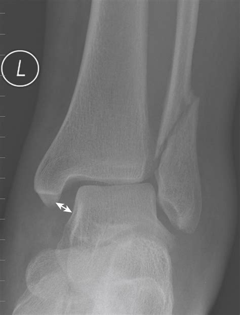 Deltoid Ligament Injection Clinical Tree