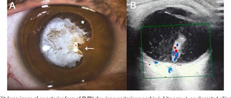Persistent Hyperplastic Primary Vitreous
