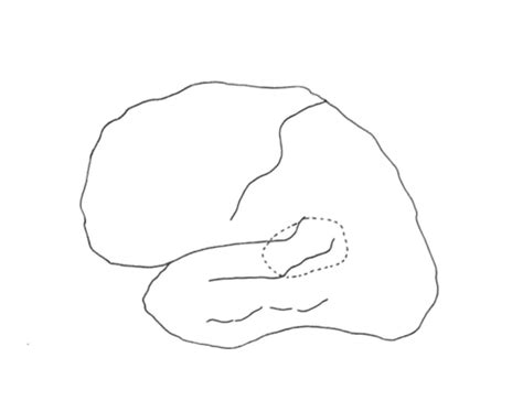 Aphasia Classifications Flashcards Quizlet