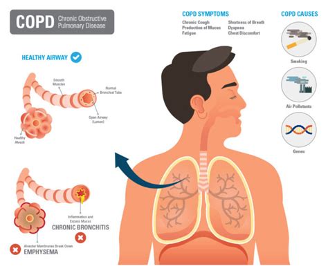 Asthma COPD Legacy For Airway Health