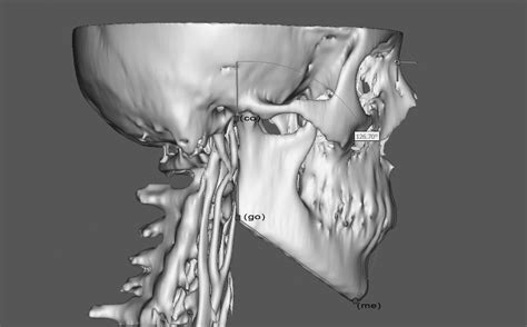 Depiction Of The Gonial Angle Co Indicates Mandibular Condyle Go