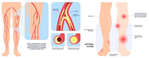 Arterial Ulcer Treatment In Los Angeles