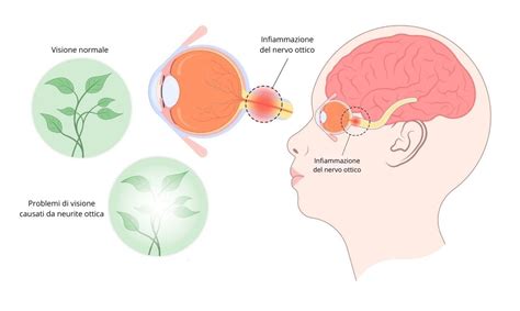 Neurite Ottica Sintomi Cause E Cura Santagostino