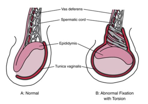 Testicular Torsion Flashcards Quizlet