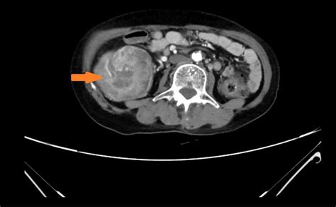 Computed Tomography Revealed Ascending Colonic Intussusception