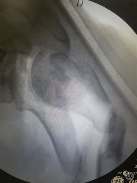 Complex Humeral Head Split Fracture Dislocation