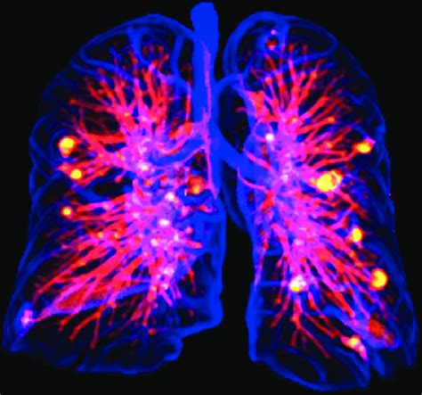 Hesse Rendering Of A Thoracic CT Scan 0 6 0 6 1 5 Mm Voxel