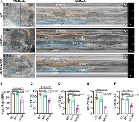 Missense Mutation In Human Chd4 Causes Ventricular Noncompaction By Repressing Adamts1 Pmc