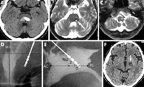 A Computed Tomography Ct Scan Showing A Haematoma In The Pontine