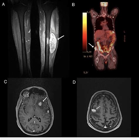 Mri Of The Left Leg Showing Intramuscular Mass In The Tibialis Anterior