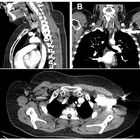 Photograph Of Whole Body Ct Scan Showing A Well Circumscribed Mixed