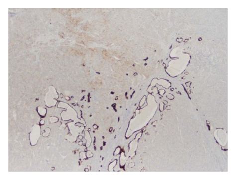 Metastasis To The Perigastric Lymph Nodes A Ck7 And B Ck20 Images