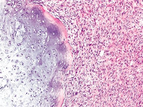 Pathology Outlines Dedifferentiated Chondrosarcoma