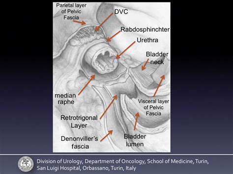 Total Anatomical Reconstruction During Robot Assisted Radical