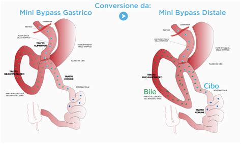 Conversione Da Mini Bypass Gastrico Dott Federico Messina
