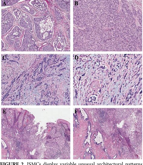 Figure 2 From Invasive Stratified Mucin Producing Carcinoma Ismc Of