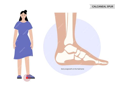 Premium Vector Calcaneal Spur Anatomy Foot Problem Diagnostic And