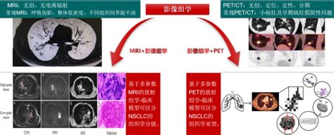 陈良安教授：影像组学优势在哪？为何要试提出“影像免疫组学”概念？从影像新技术到内镜与机器人，谈现代科技的肺癌早期诊断腾讯新闻