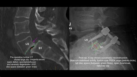 Spondylolisthesis Surgery Before And After