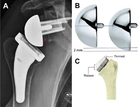 A Association Of A Lateralized Glenoid Component Red Arrow An