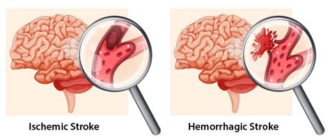 Pontine Stroke Causes Symptoms Treatment And Recovery