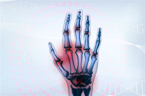 Updated Treatment Recommendations For Rheumatoid Arthritis