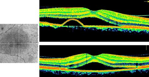 For Central Serous Chorioretinopathy Wait And See No More Ophthalmology Advisor