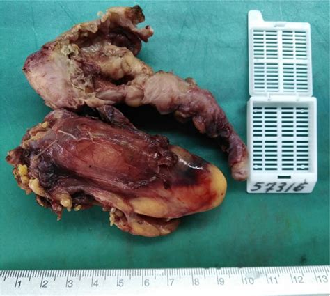 Gross Specimen Of The Strangulated Perforated And Resected Appendix